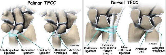 TFCC Injury - Hand - Orthobullets